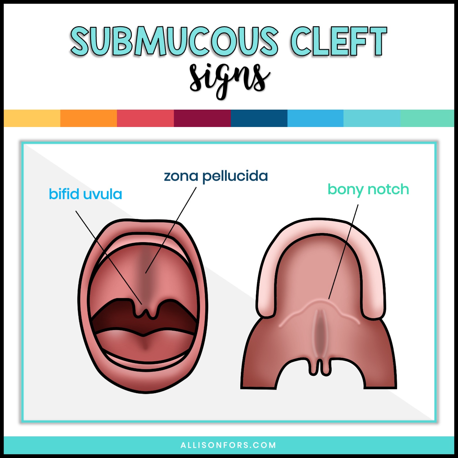 Signs and Symptoms of Submucous Cleft Palate | Allison Fors, Inc.