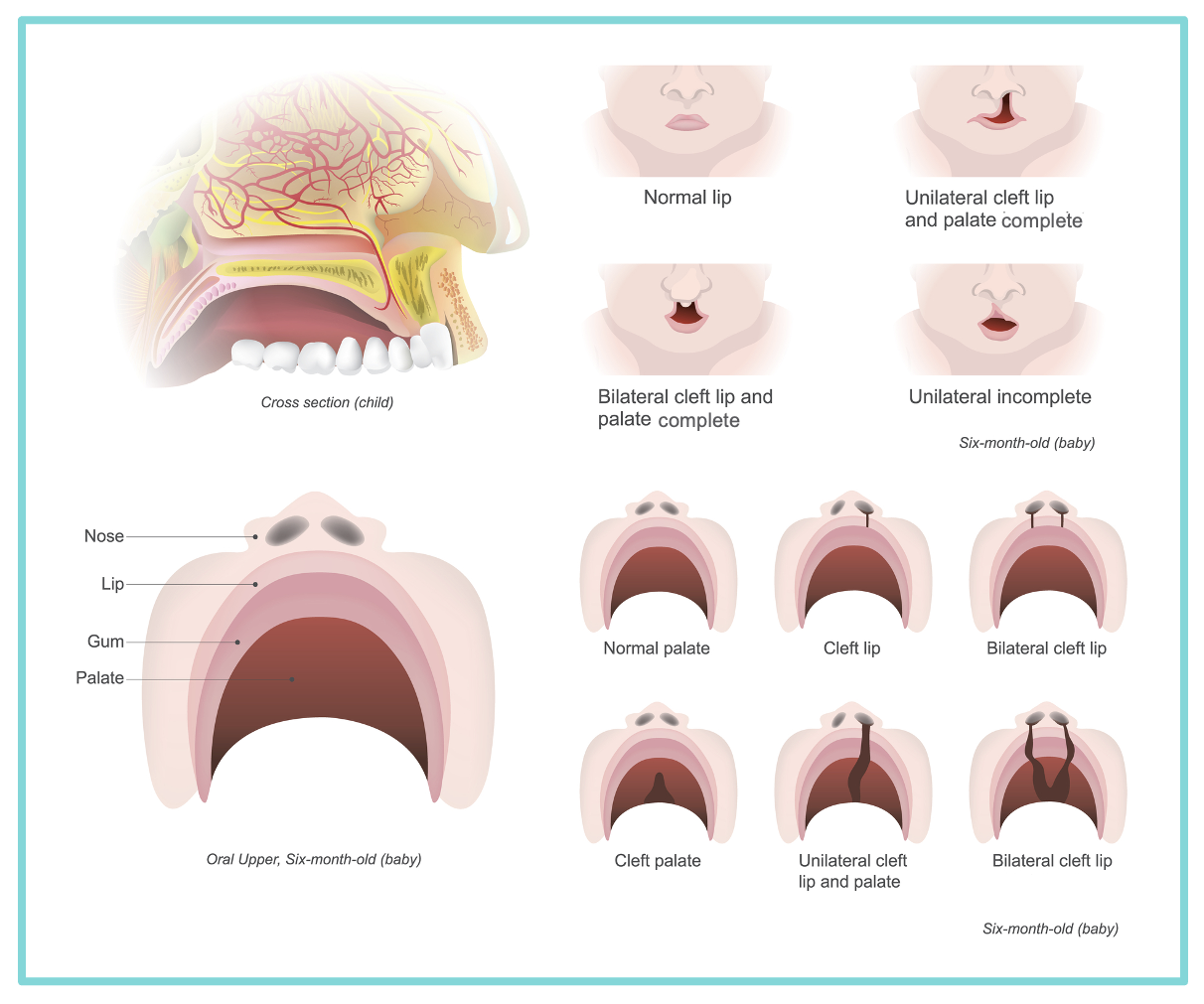 Cleft Lip and Palate Speech Therapy Intervention | Allison Fors