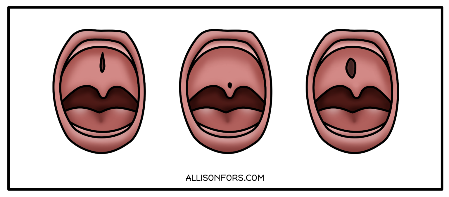 Velopharyngeal Insufficiency: A Guide for SLPs and SLPAs